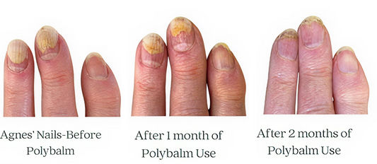 Before & After Polybalm® — Real Patient Results | Polybalm USA ...