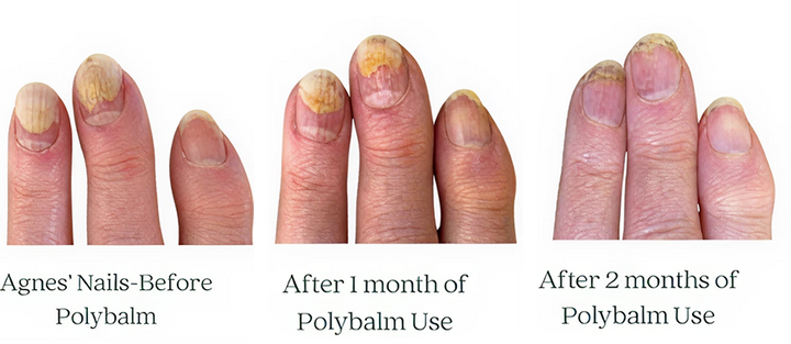 Before & After Polybalm® — Real Patient Results | Polybalm USA ...