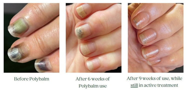 Polybalm® USA |Clinically Proven Nail Repair for Chemo & Damaged Nails ...