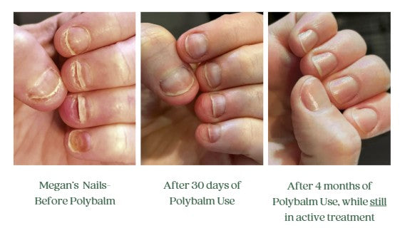 Nail Balm for Chemotherapy Nail Damage | yes Polybalm® USA – PolybalmUSA