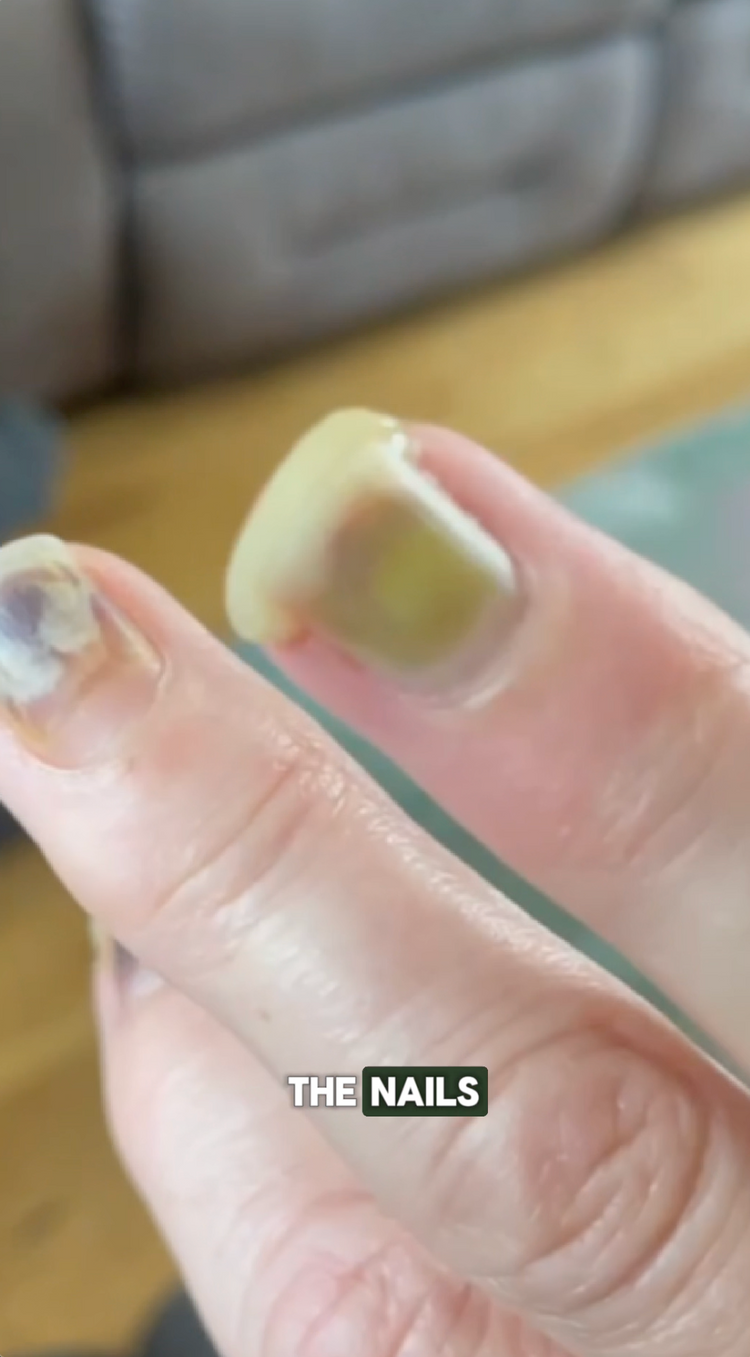 Nail Balm for Chemotherapy Nail Damage | yes Polybalm® USA – PolybalmUSA