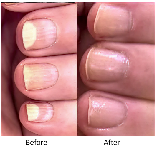 Before & After Polybalm® — Real Patient Results | Polybalm USA ...