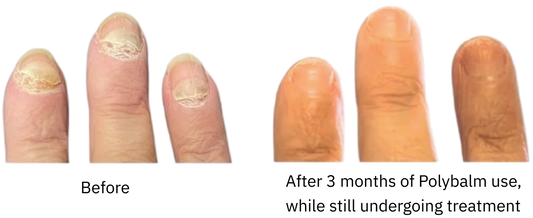 Before & After Polybalm® — Real Patient Results | Polybalm USA ...