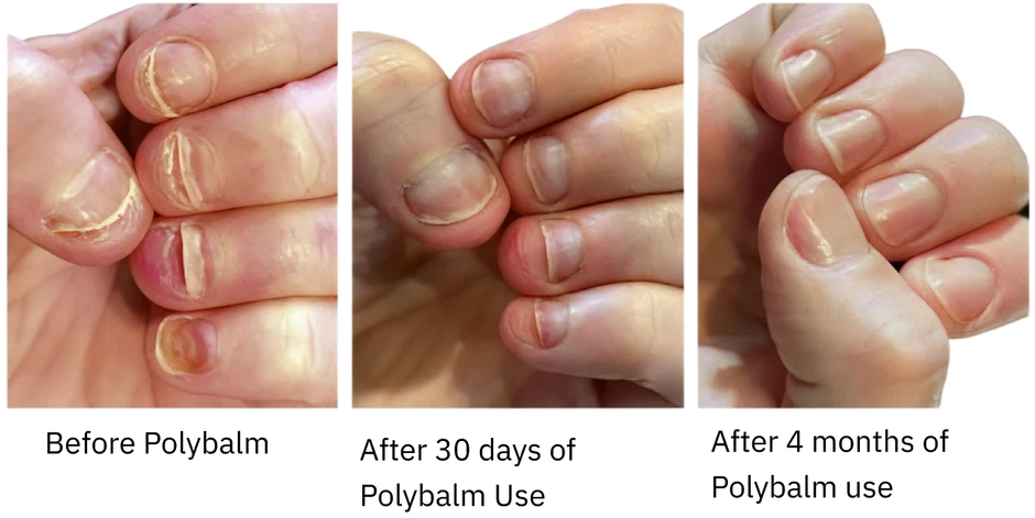 Before & After Polybalm® — Real Patient Results | Polybalm USA ...